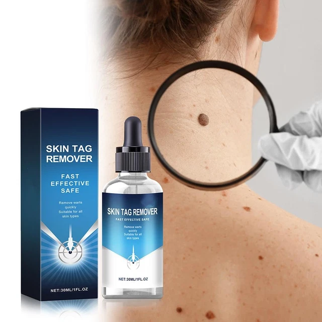SKIN TAG MOLE Wart Remover Removal Cream Ointment Fast Safe A U ...