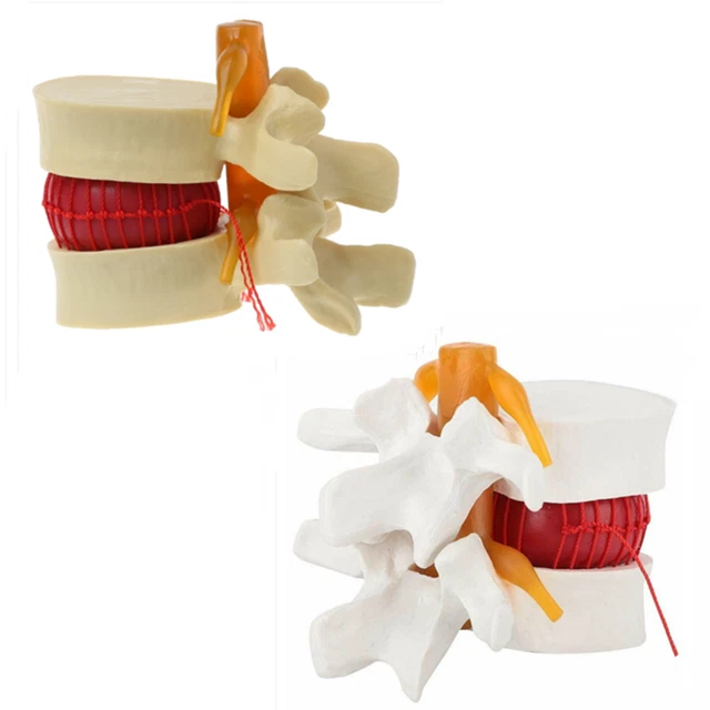 Lumbar Vertebrae Model Anatomical Lumbar Disc Herniation Anatomy 0939