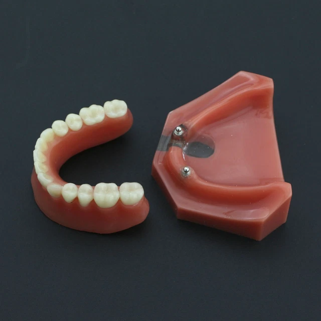DENTAL IMPLANT OVERDENTURE Lower Jaw Model Patient Education NISSIN ...