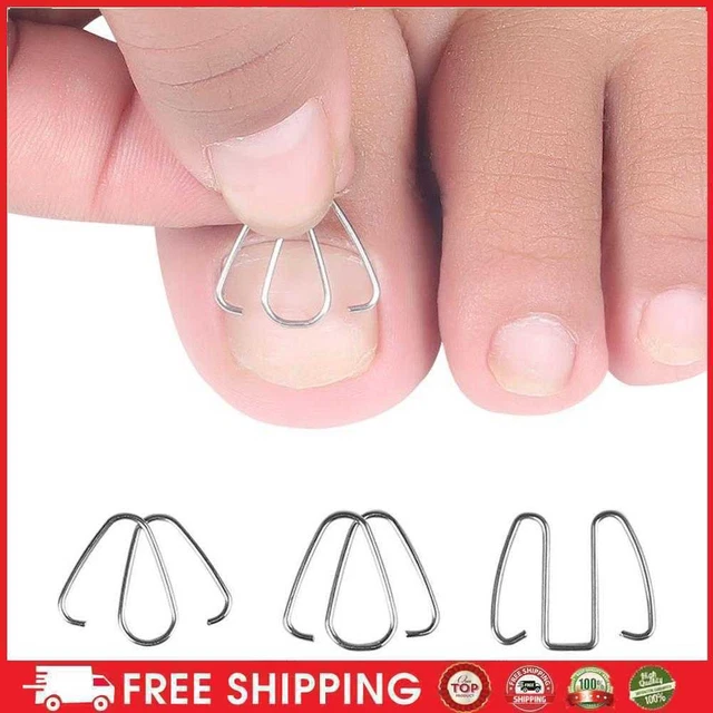 INGROWN TOE NAIL Correction Hook/Rubber Band Paronychia Orthosis ...