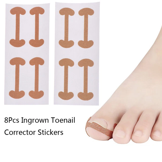 8* INGROWN TOENAIL Paronychia Treatment Foot Corrector Stickers Toe ...