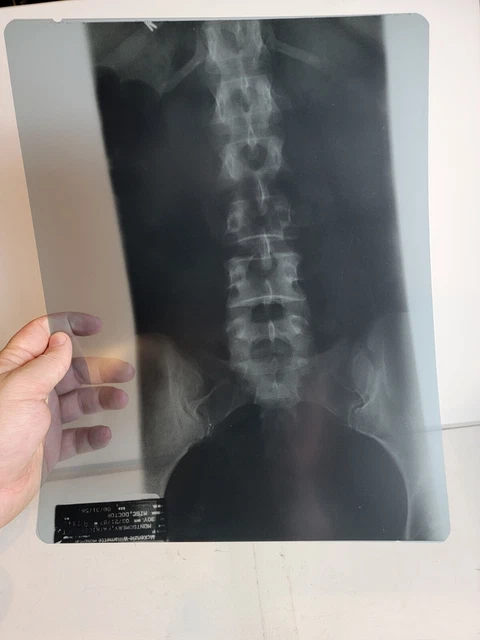 Vintage Radiology X Ray Picture Sheet 1980s Spine Cervical 1987 14 X 3584