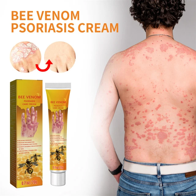 BEE VENOM PSORIASIS Care Cream Dermatitis Eczema Ointments Healing ...
