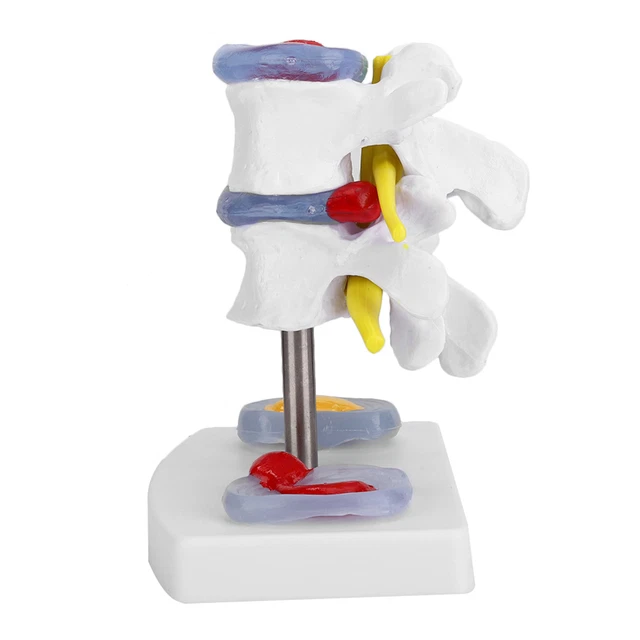 ANATOMICAL LUMBAR DISC Herniation Demonstration Model Human Spine ...