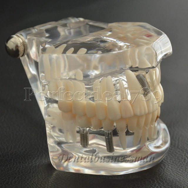 DENTAL STUDY TEACH Implant Teeth Model Restoration Bridge Caries ...