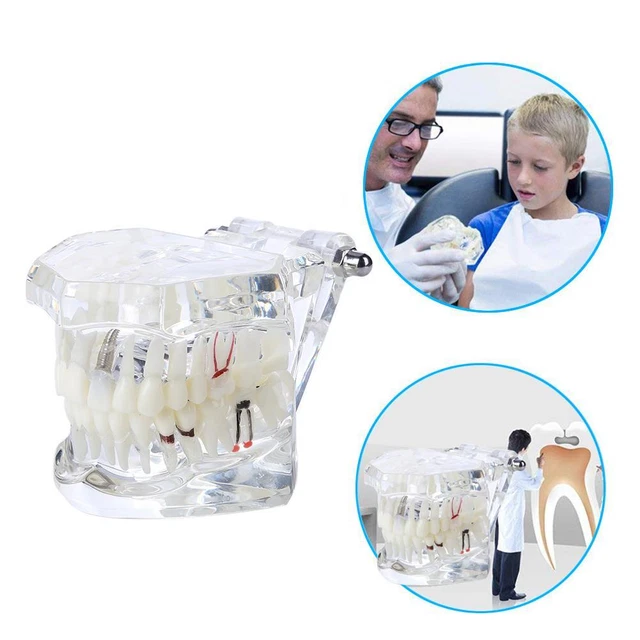 PVC TOOTH DECAY Model Occlusal Oral Tooth Models Removable Medical ...