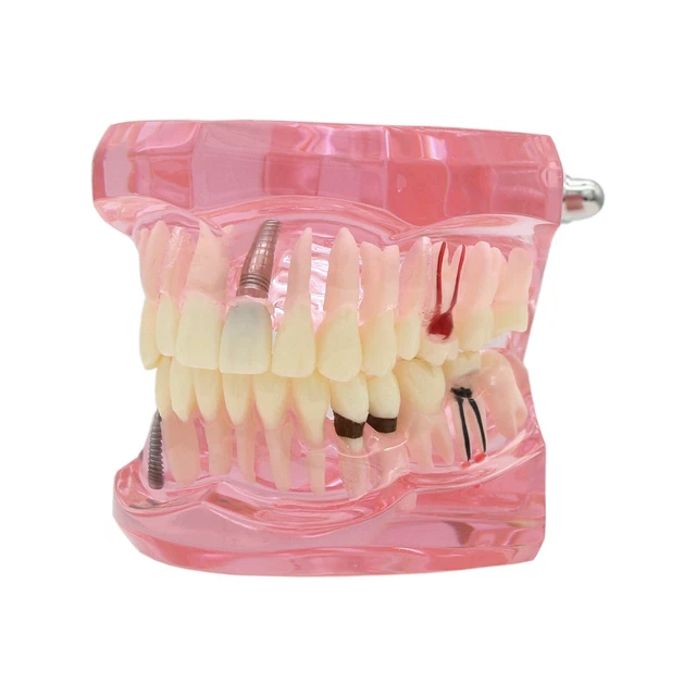 DENTAL IMPLANT TEETH Model Teach Study Demo Restoration Pathology ...