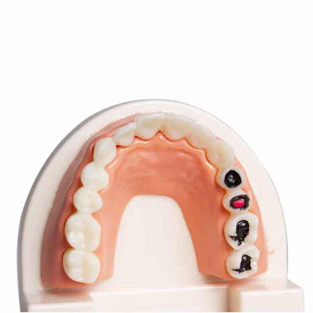 DENTAL TEETH MODEL Study Cavities Mode Model Standard Dentist Decay ...