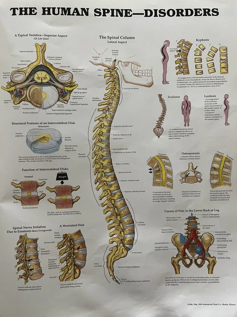 THE ANATOMICAL CHART ~ The Human Spine-Disorders ~ 11.25 x 14 Poster ...