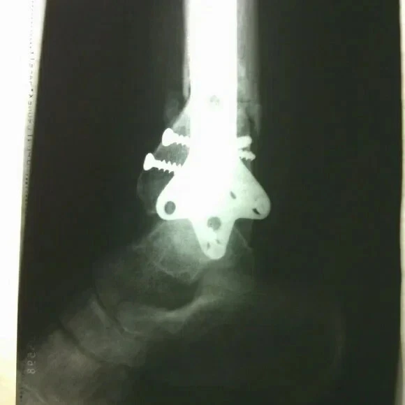 HOSPITAL MEDICAL X-RAYS Human Anatomy Leg Ankle Plate Fracture Tibia ...