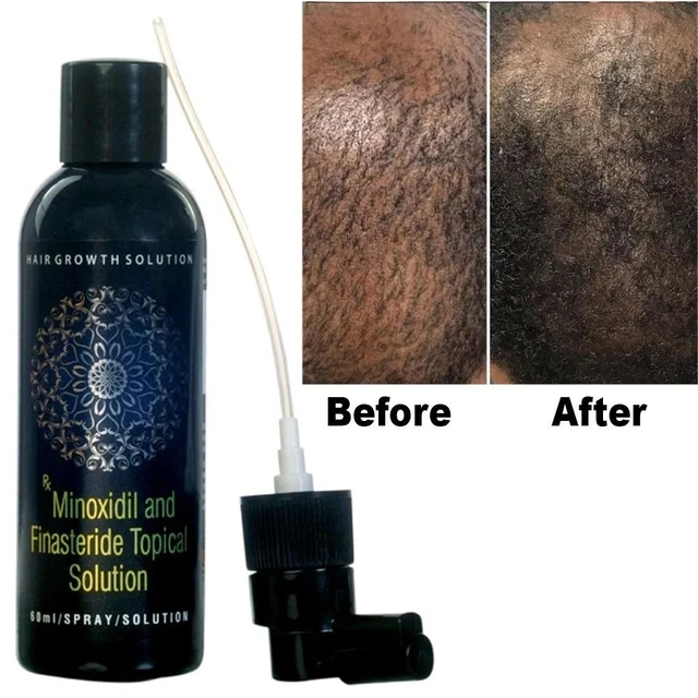 HAIR GROWTH TOPICAL Solution Spray Advanced Regrowth Formula ( New With ...