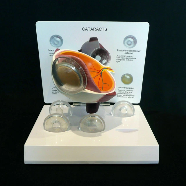 Eye Diseases Cataract