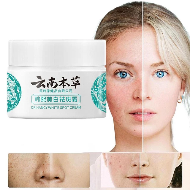 JAPANESE MELASMA CREAM, Cream Japan,Dr Hancy White Spot Face Freckle ...