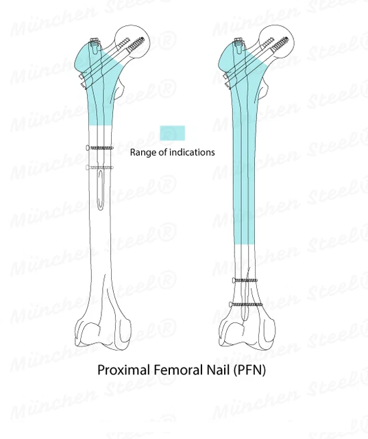 PFN-(PROXIMAL-FEMORAL-NAIL-TITANIUM-10-UNIT-WITH-1-UNIT-END-CAP-AND-4-UNIT-SCREW EUR 1.021,58 ...