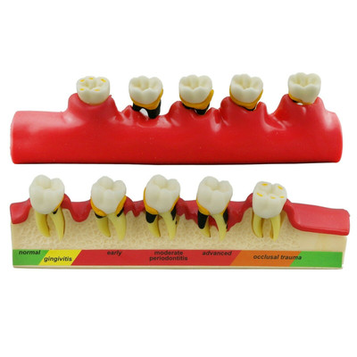 DENTAL TEETH MODEL Periodontal Disease Typodont Models Periodontics ...