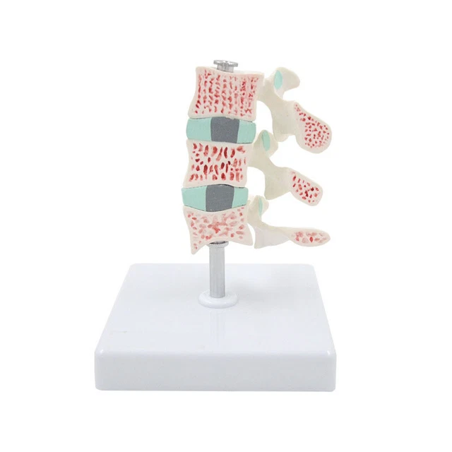HUMAN SKELETON OSTEOPOROSIS Lesion Joint Model Skeletal Spine Cervical ...