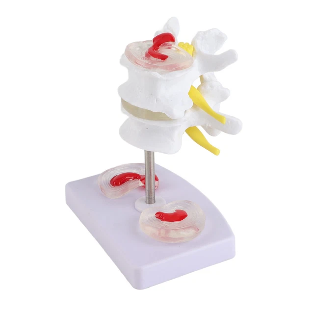 ANATOMICAL LUMBAR DISC Herniation Demonstration Model Spine School ...
