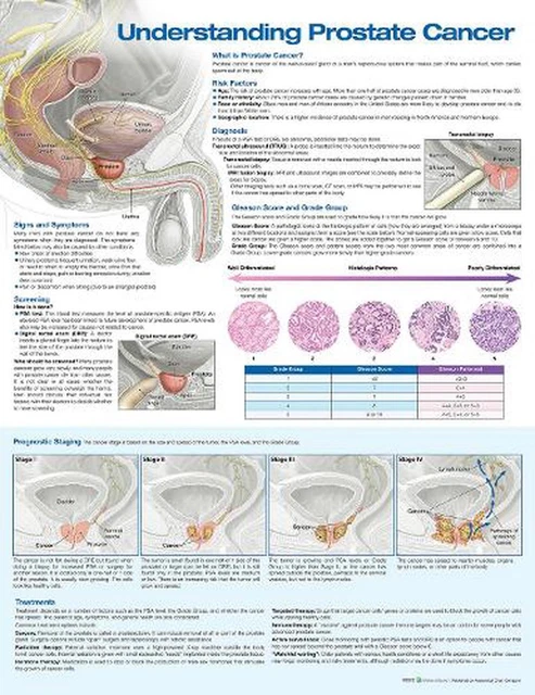 UNDERSTANDING PROSTATE CANCER Anatomical Chart by Anatomical Chart Company Wall $54.86 - PicClick AU