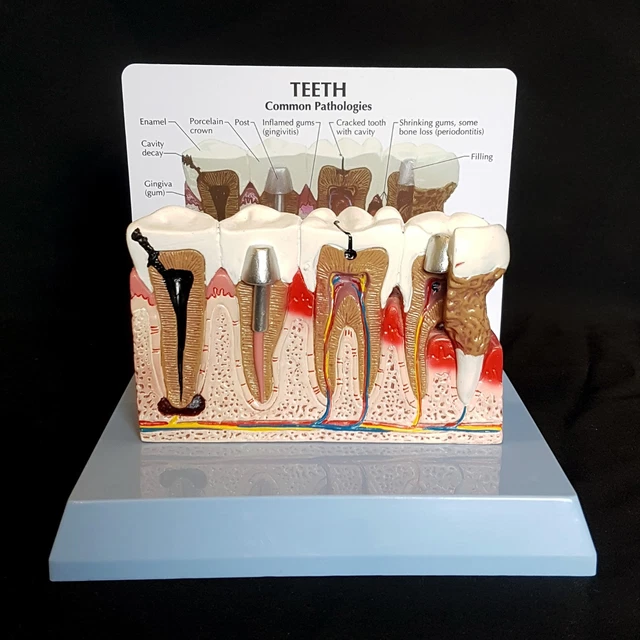 ANATOMICAL DISEASED TEETH and Gums Model - Dental Hygiene Medical Tooth ...