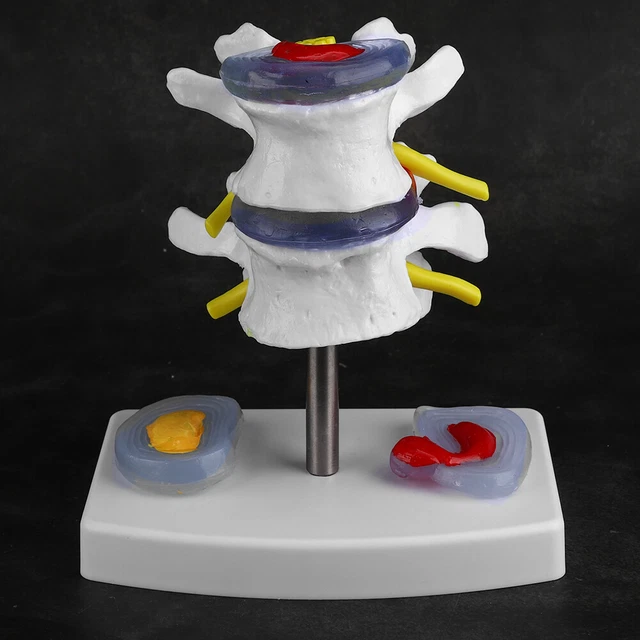 LUMBAR MODEL ANATOMICAL Lumbar Disc Herniation Demonstration Model ...