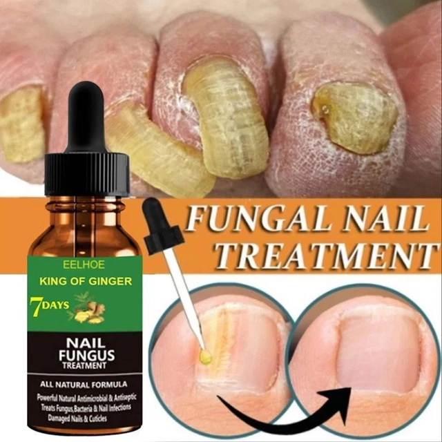 CARE HEALTHY FOOT Treatment Solution Fungal Remove Anti-fungal ...