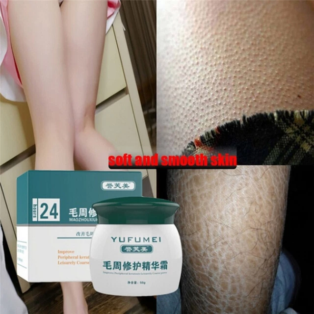Curing Keratosis Pilaris Kp Chicken Skin Body Lotion Skin Repair