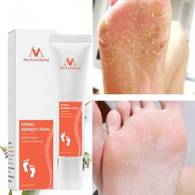 15ML FOOT CREAM Anti Fungal Infection Fungus Gel Repair Dry Crack Toe ...