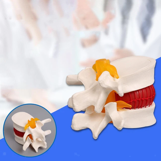 LUMBAR DISC HERNIATION Model Lumbar Spine Model Anatomy Tool for ...