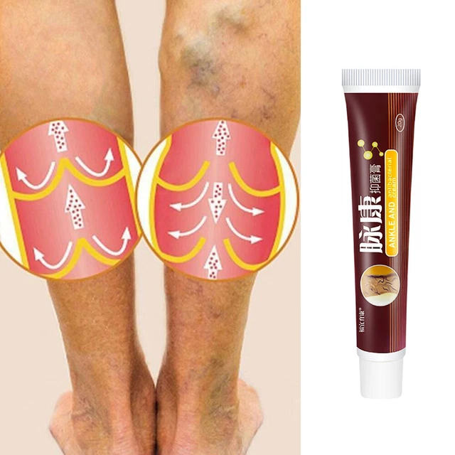 2PC VARICES MEDICAL Cream Testicular Varicocele Ointment Treatment Leg ...