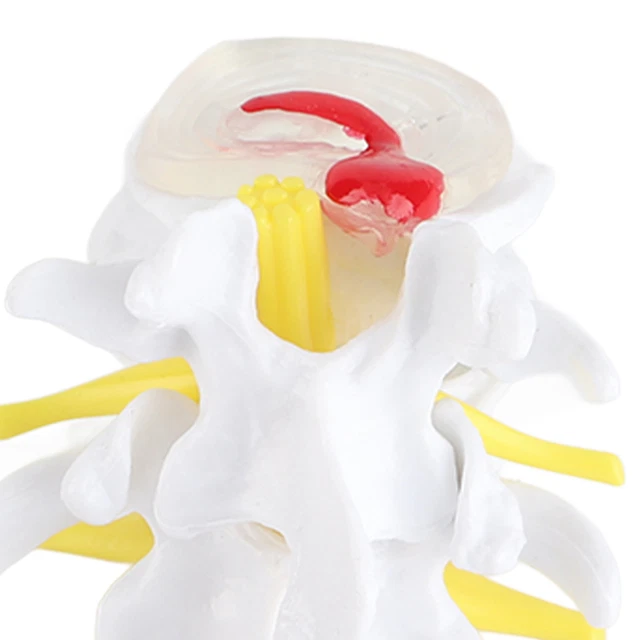 ANATOMICAL LUMBAR DISC Herniation Model Human Spine For Teaching HMO ...