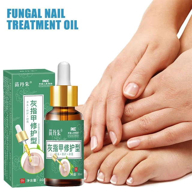 FUNGAL NAIL FUNGUS Treatment Damaged Discoloration Cuticles n ew Relief ...