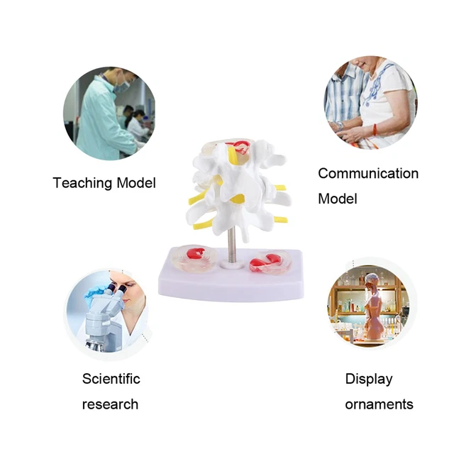 ANATOMICAL LUMBAR DISC Herniation Demonstration Model Human Spine ...