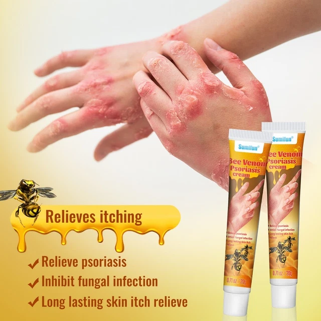 BEE VENOM PSORIASIS Cream Dermatitis Eczema Pruritus Ointment Skin Anti ...