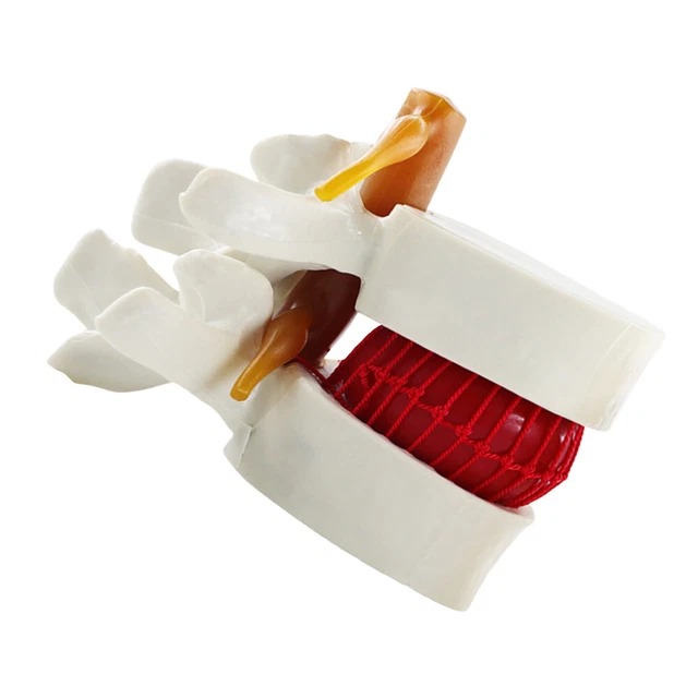 White Pvc Intervertebral Disc Model Lumbar Spine Herniation £1943 2656