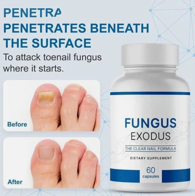 Fungus Exodus For Toenail Fungus Reviews