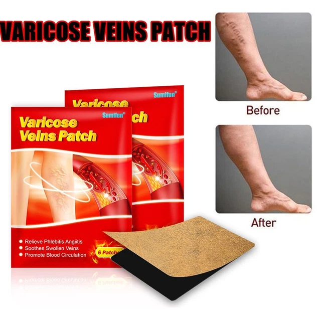 ROTTEN VASCULITIS CREAM Health Care Varicose Veins Patches Ointment ...