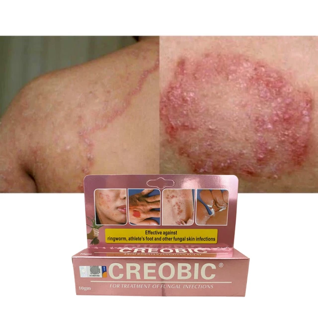 CRÈME DE TRAITEMENT de la gale créobique guérison peau teigne parasites ...