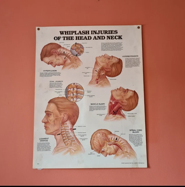 ANATOMICAL MEDICAL POSTERS The Anatomical Chart Co - Whiplash Head And ...