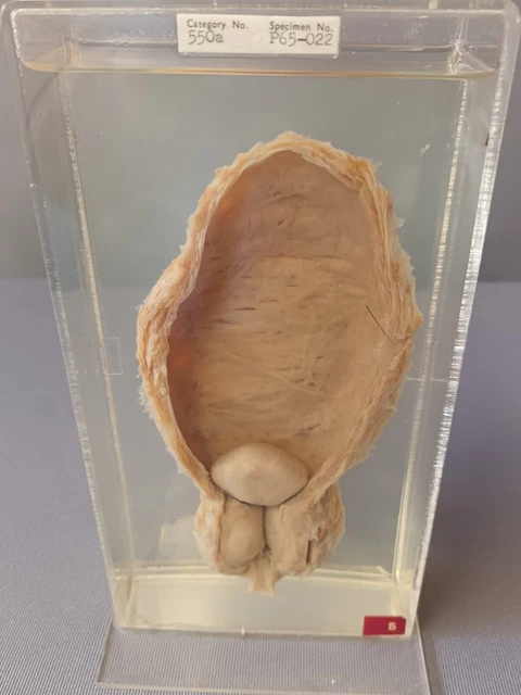 TAXIDERMY WET SPECIMEN of a Human Bladder Showing Tumours £200.00 ...