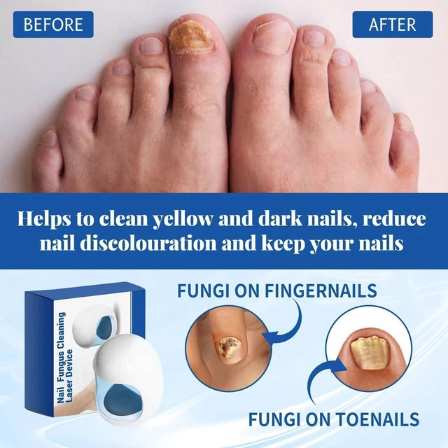 2024 HOT NAIL Fungus Laser-Device Light Therapy Onychomycosis Toes ...