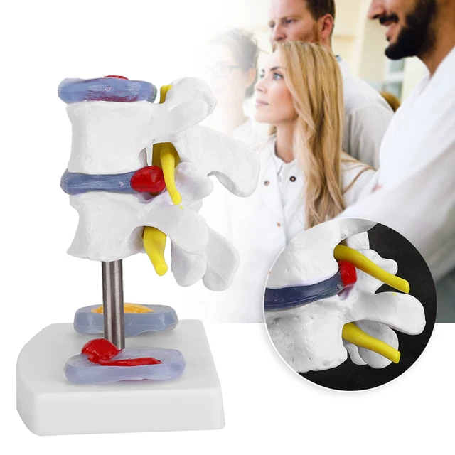 ANATOMICAL LUMBAR DISC Herniation Demonstration Model Human Spine ...