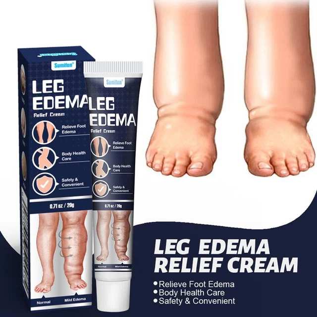 LEG SWELLING ANTI-EDEMA Cream Relief Patch Massage Care Body Edema Crea ...