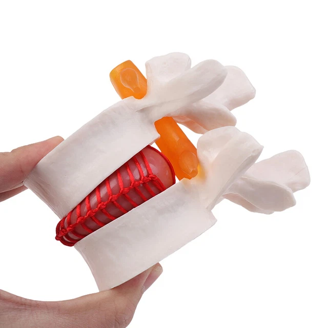 HUMAN ANATOMY SKELETON Spine Lumbar Disc Herniation Teaching Model ...