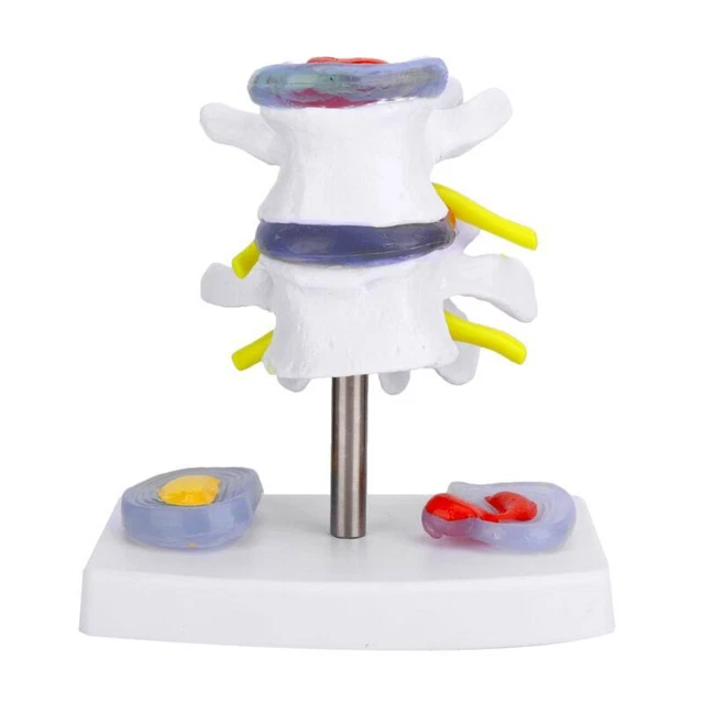ANATOMICAL LUMBAR DISC Herniation Model Human Spine Educational Tool ...