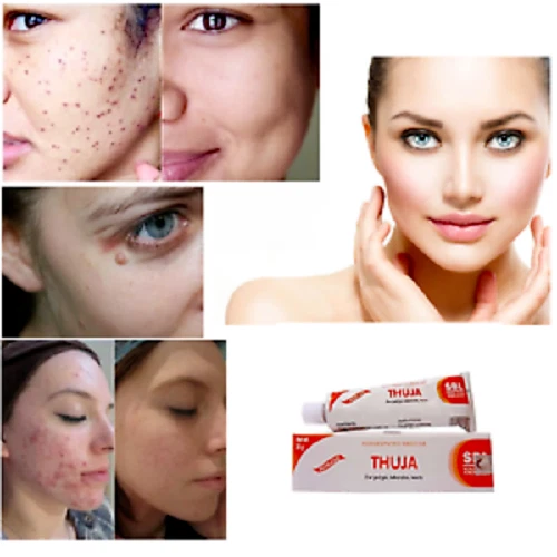 SBL THUJA OINTMENT Warts Fungal Overgrowth Dry Skin & Eruptions ...