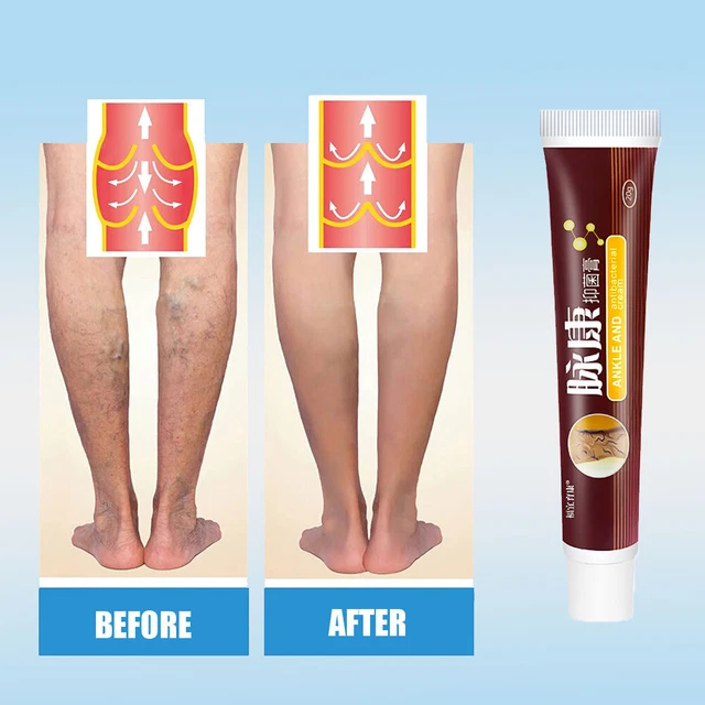 2PC VARICES MEDICAL Cream Testicular Varicocele Ointment Treatment Leg ...