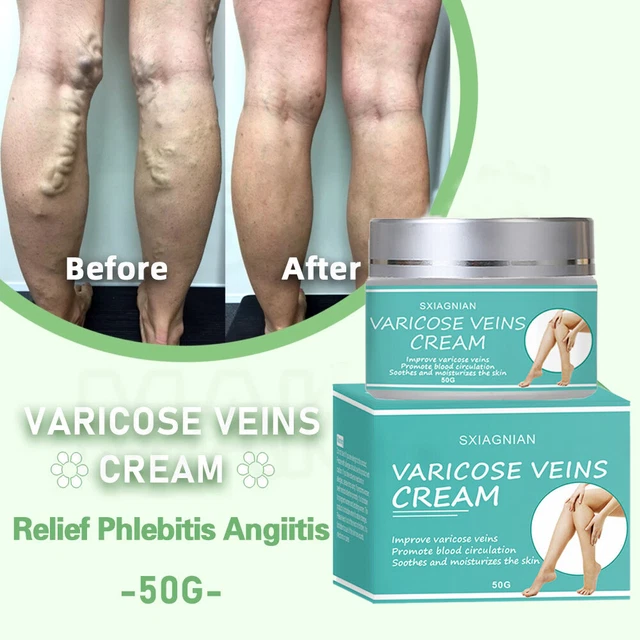 50G VARICOSE VEINS Relief Cream Vasculitis Phlebitis Spider Pain Relief ...